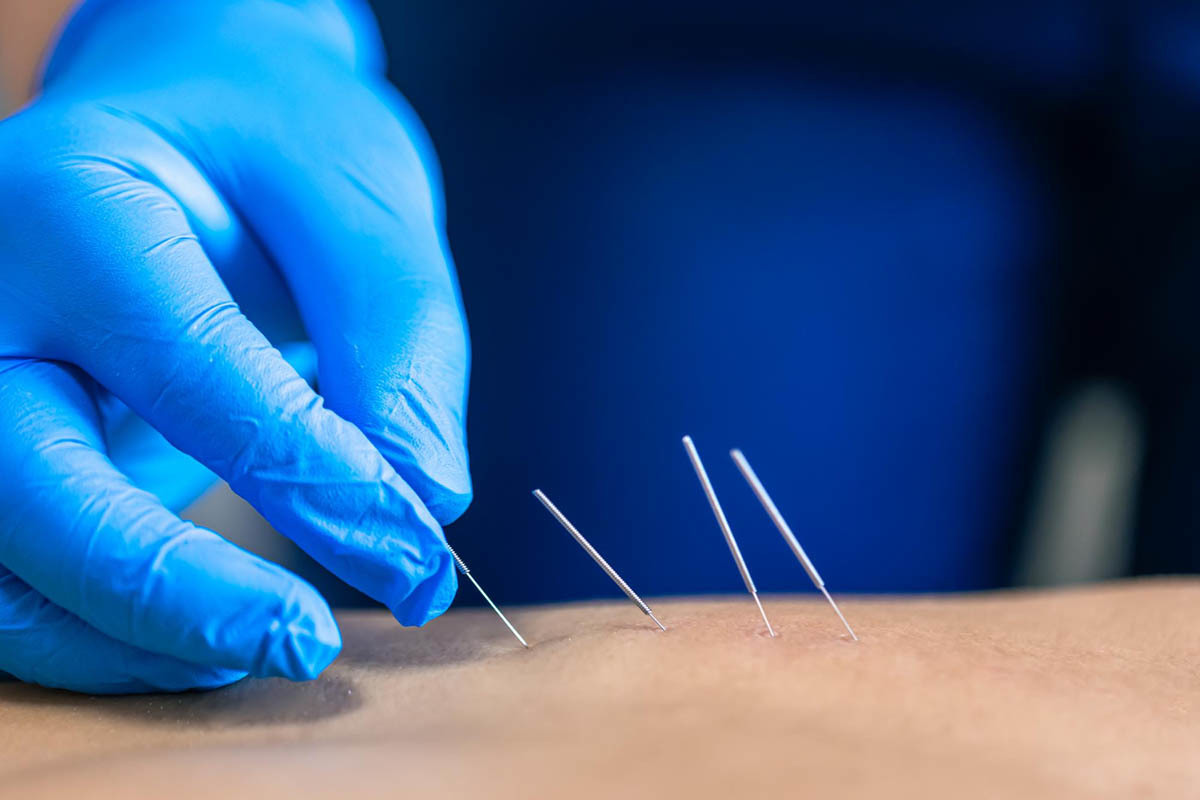 Dry Needling Therapy | Pank Chiropractic Whitehall, WI